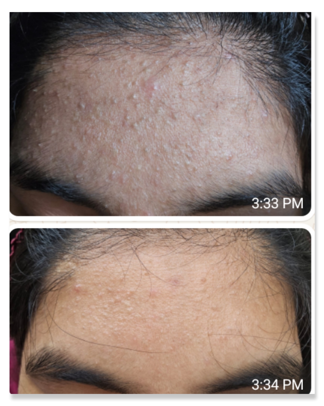 ANTI ACNE DEAL - Umab Assentials